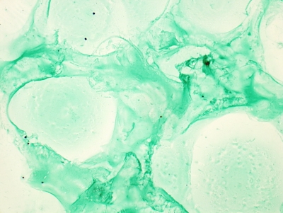 Benign follicular nodule (colloid goiter, colloid nodule, adenomatoid ...