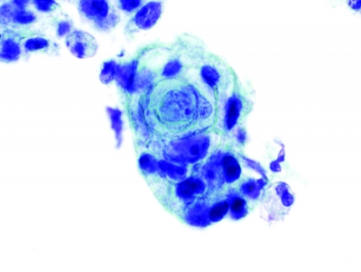 MALIGNANT: Other (Mucoepidermoid carcinoma of the thyroid) - Small ...