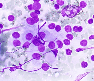 Lymphocytic (Hashimoto) thyroiditis - Oncocytic Cells and lymphocytes ...