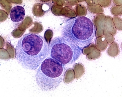Papillary Thyroid Carcinoma - Tall Cell Variant - Papillary Carcinoma ...