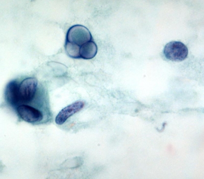 Papillary Thyroid Carcinoma - Tall Cell Variant - Papillary Carcinoma ...