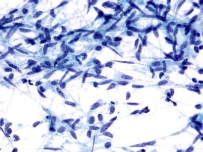 Medullary Thyroid Carcinoma - Spindle cell morphology may be prominent ...