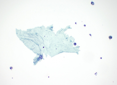 Benign follicular nodule (colloid goiter, colloid nodule, adenomatoid ...