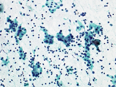 Lymphocytic (Hashimoto) thyroiditis - Lymphocytes and Hurthle cells ...