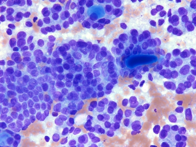 IMAGE ATLAS - Papillary Thyroid Carcinoma - Classic, Romanowsky Stain ...