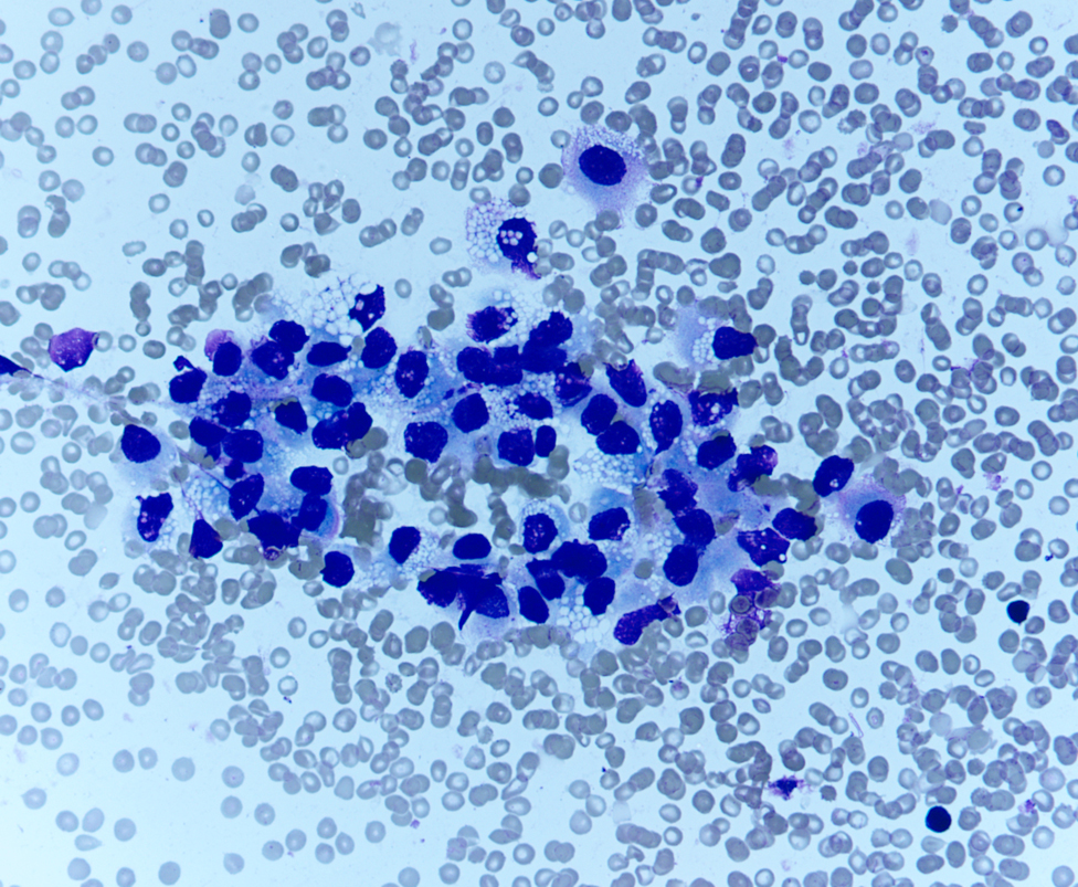 Papanicolaou Society of Cytopathology Case of the Month April 2012