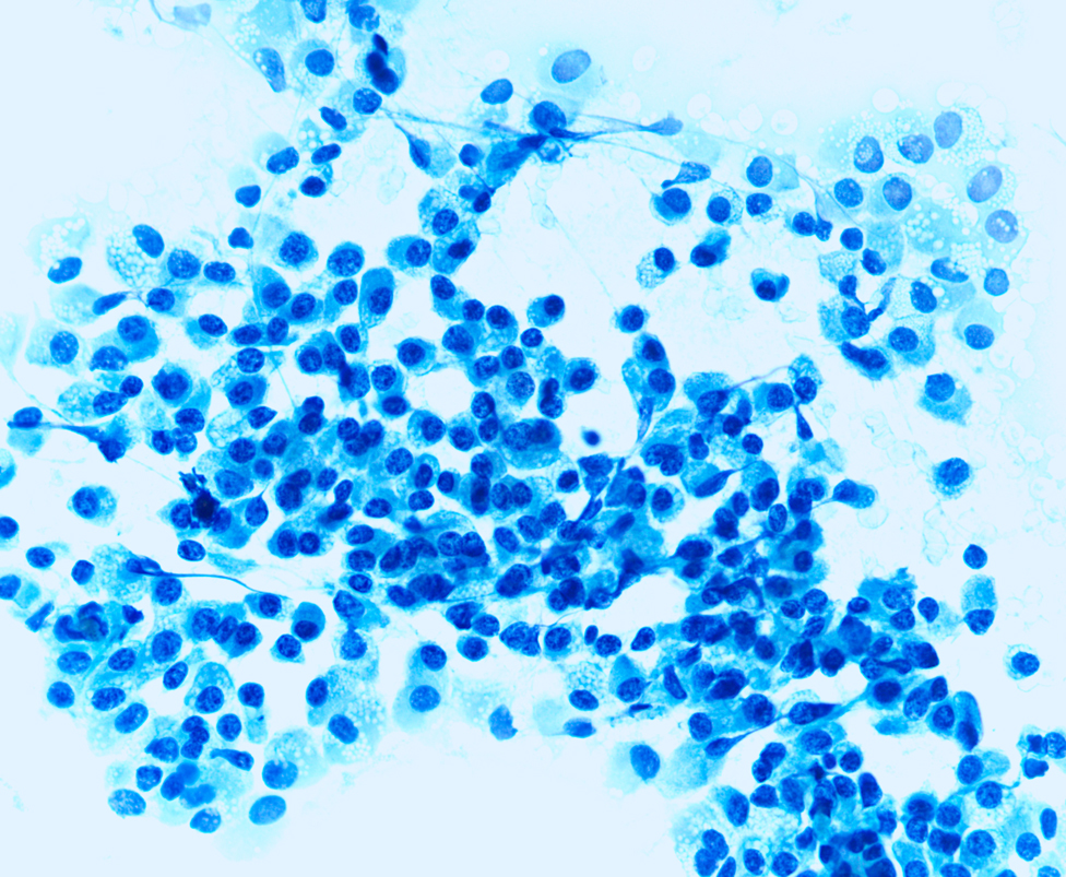 Papanicolaou Society of Cytopathology Case of the Month April 2012