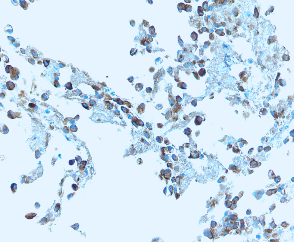 Papanicolaou Society of Cytopathology Case of the Month April 2012