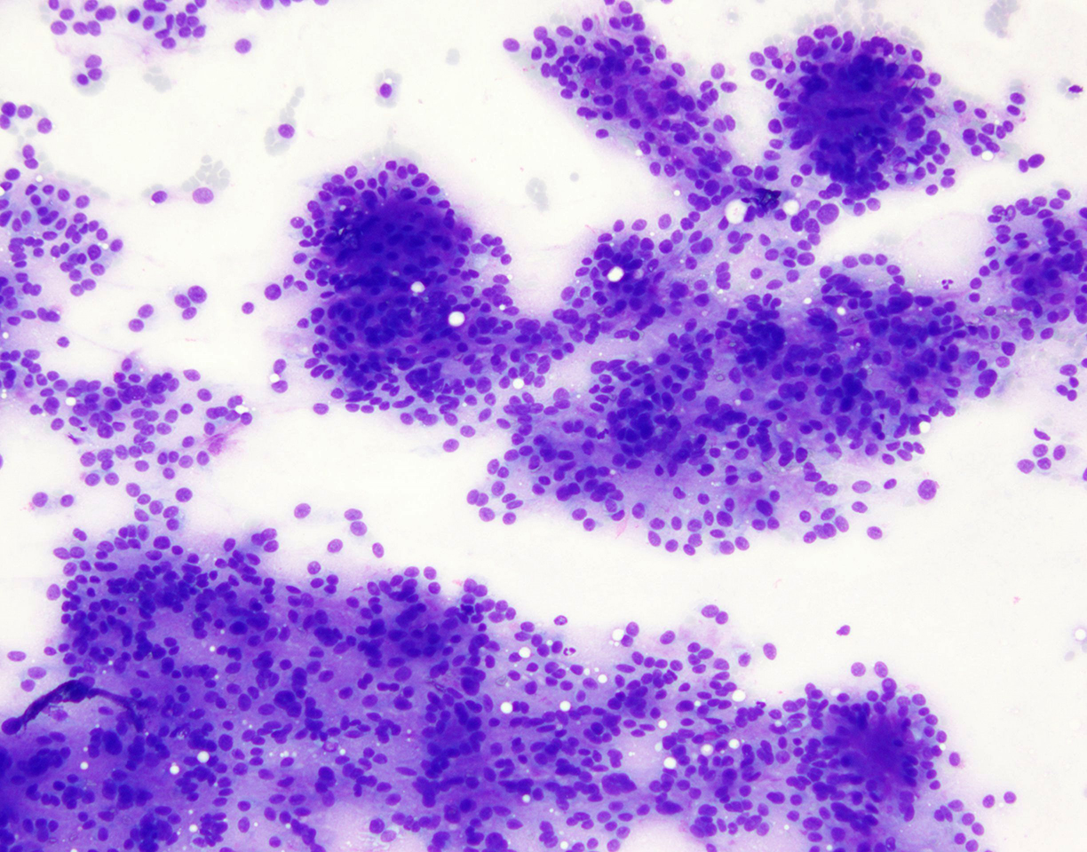 Papanicolaou Society of Cytopathology Case of the Month April 2016