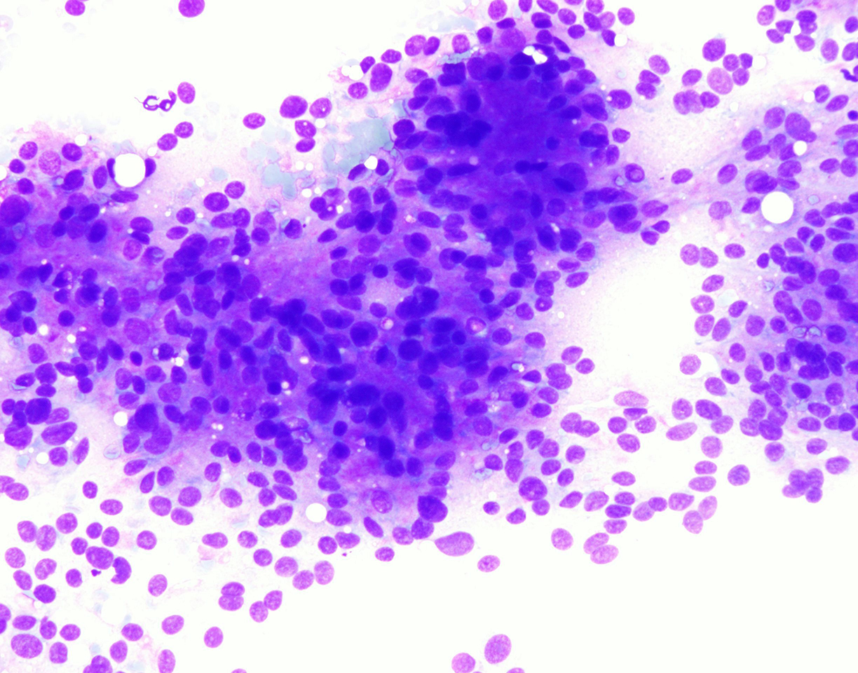 Papanicolaou Society of Cytopathology Case of the Month April 2016