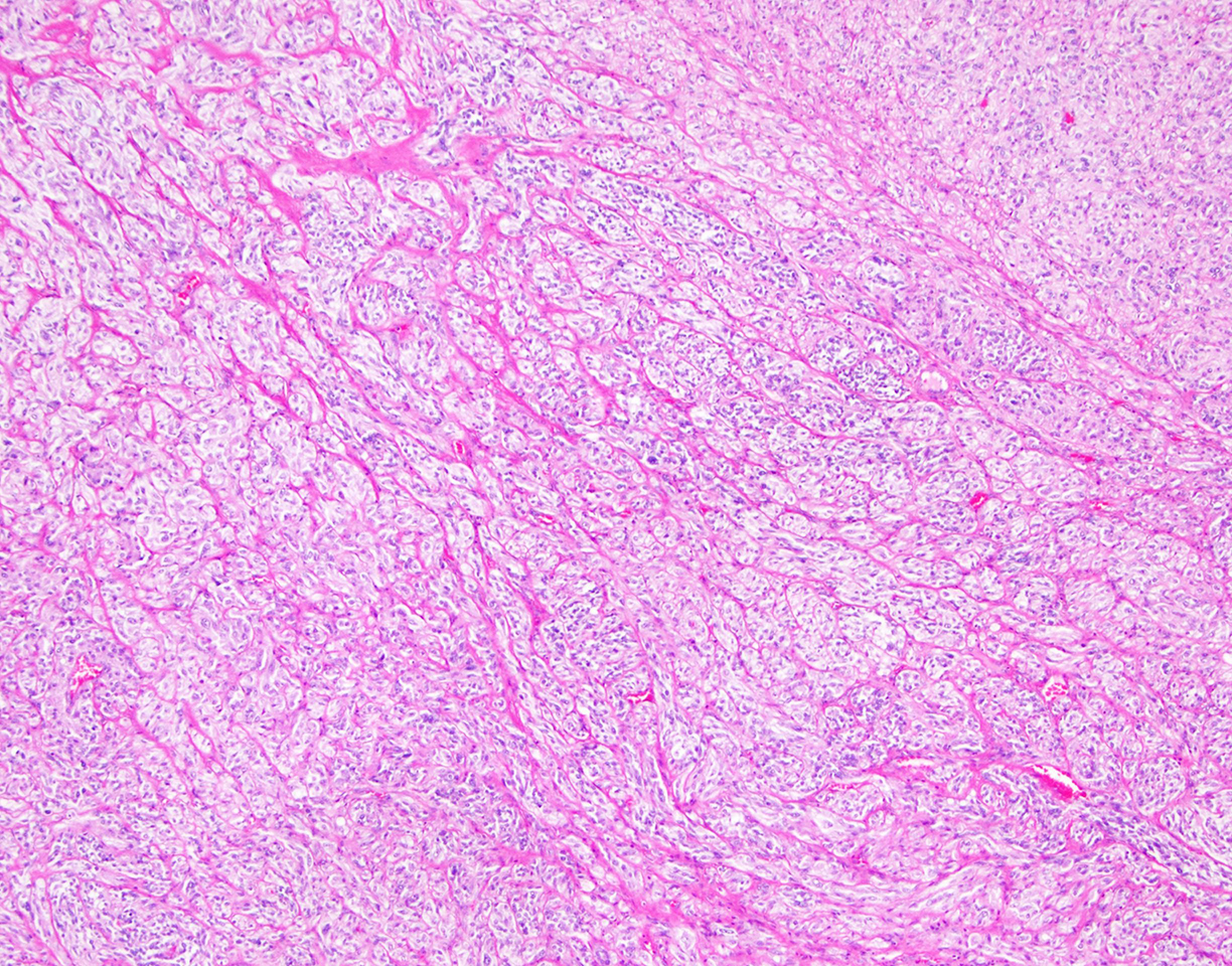 Papanicolaou Society of Cytopathology Case of the Month April 2016