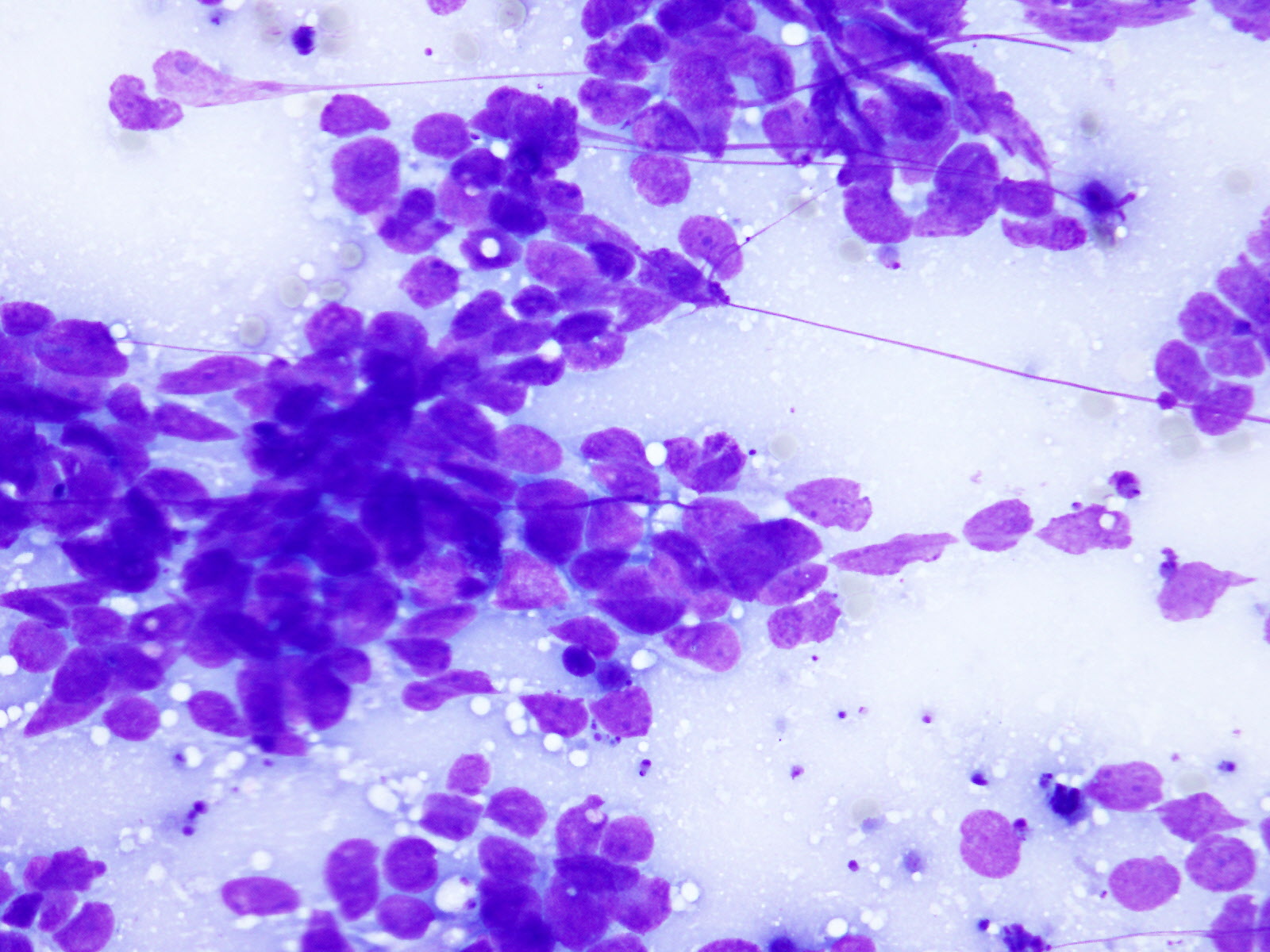 Papanicolaou Society of Cytopathology Case of the Month August 2013