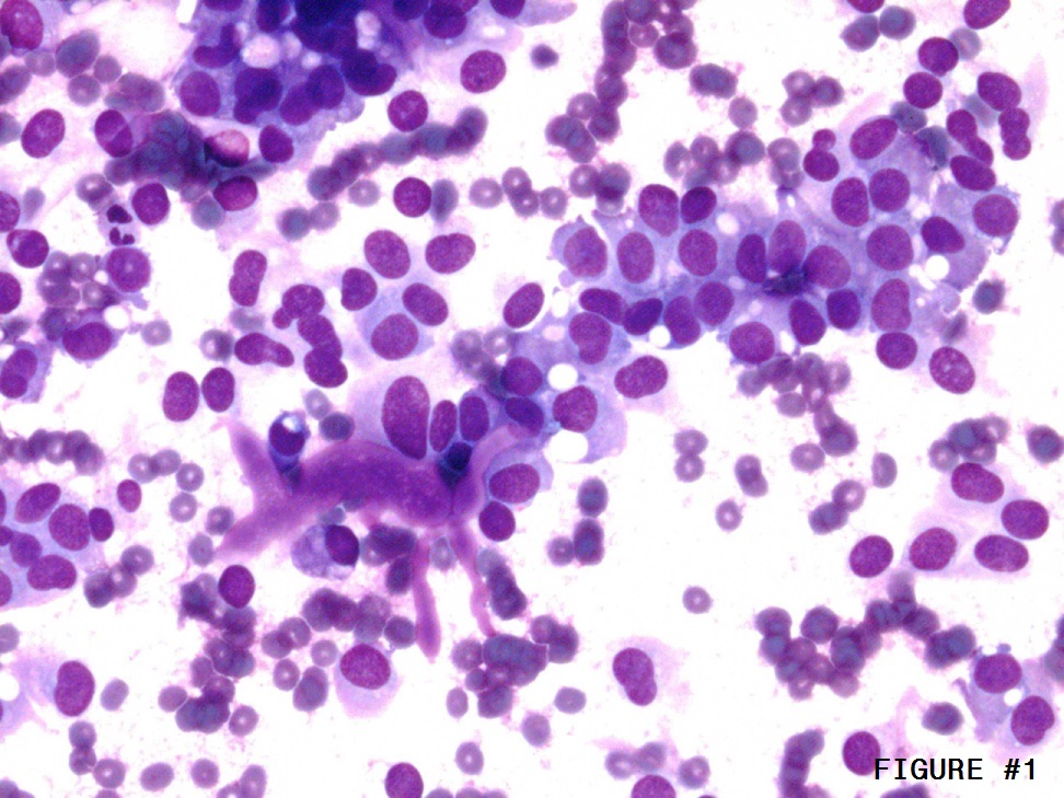 Papanicolaou Society of Cytopathology Case of the Month August 2014
