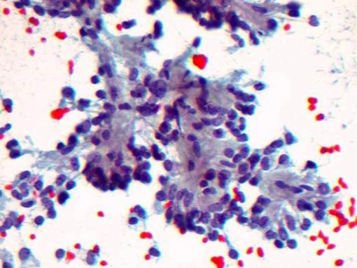 Papanicolaou Society of Cytopathology Case of the Month August 2014