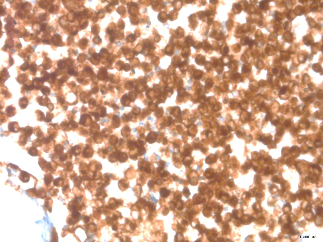 Papanicolaou Society of Cytopathology Case of the Month August 2014