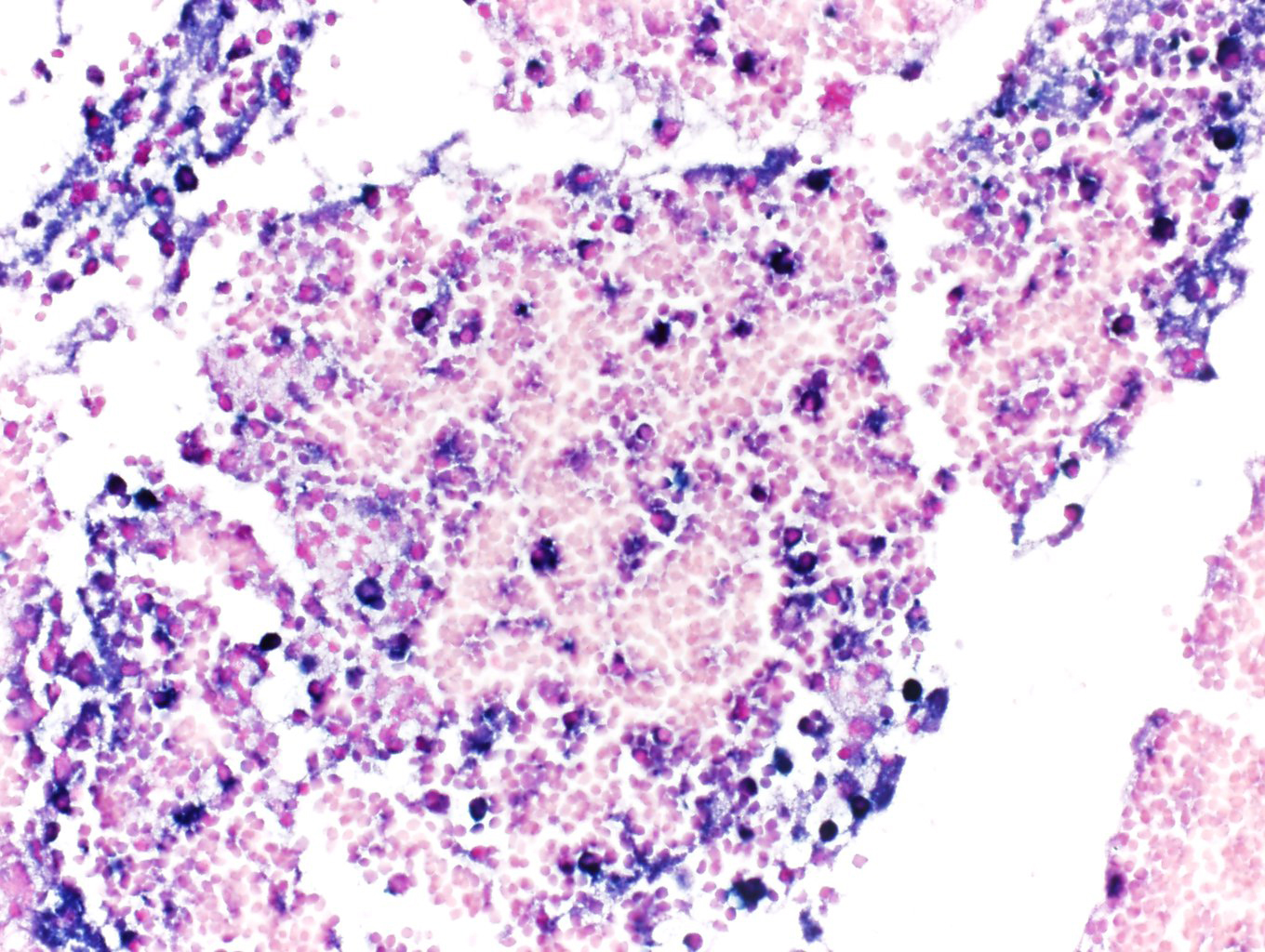 Papanicolaou Society of Cytopathology Case of the Month October 2016