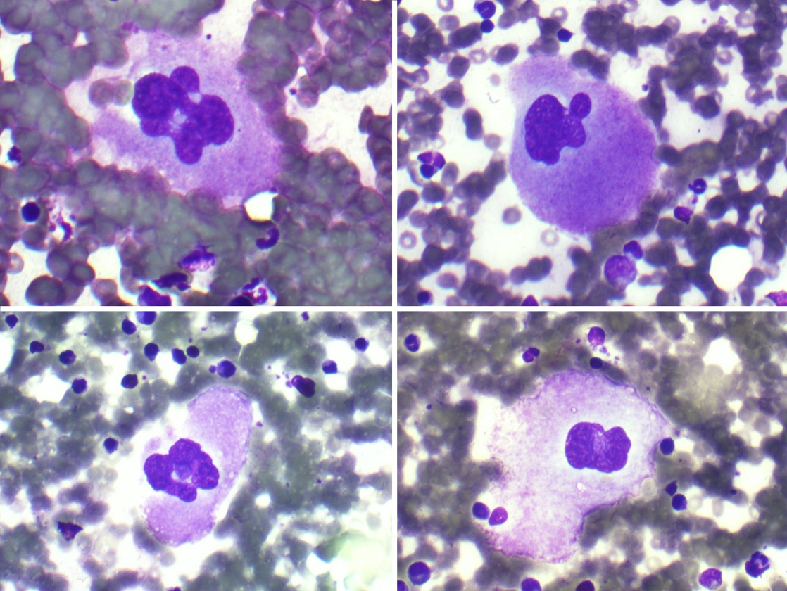 Papanicolaou Society of Cytopathology Case of the Month February 2014