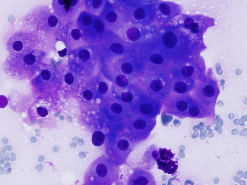 Papanicolaou Society of Cytopathology Case of the Month April 2016