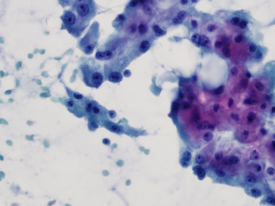 Papanicolaou Society of Cytopathology Case of the Month April 2016