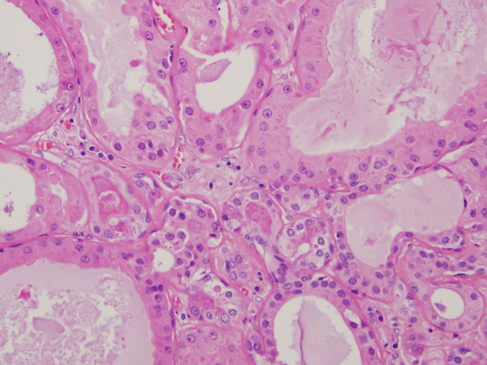 Papanicolaou Society of Cytopathology Case of the Month March 2016