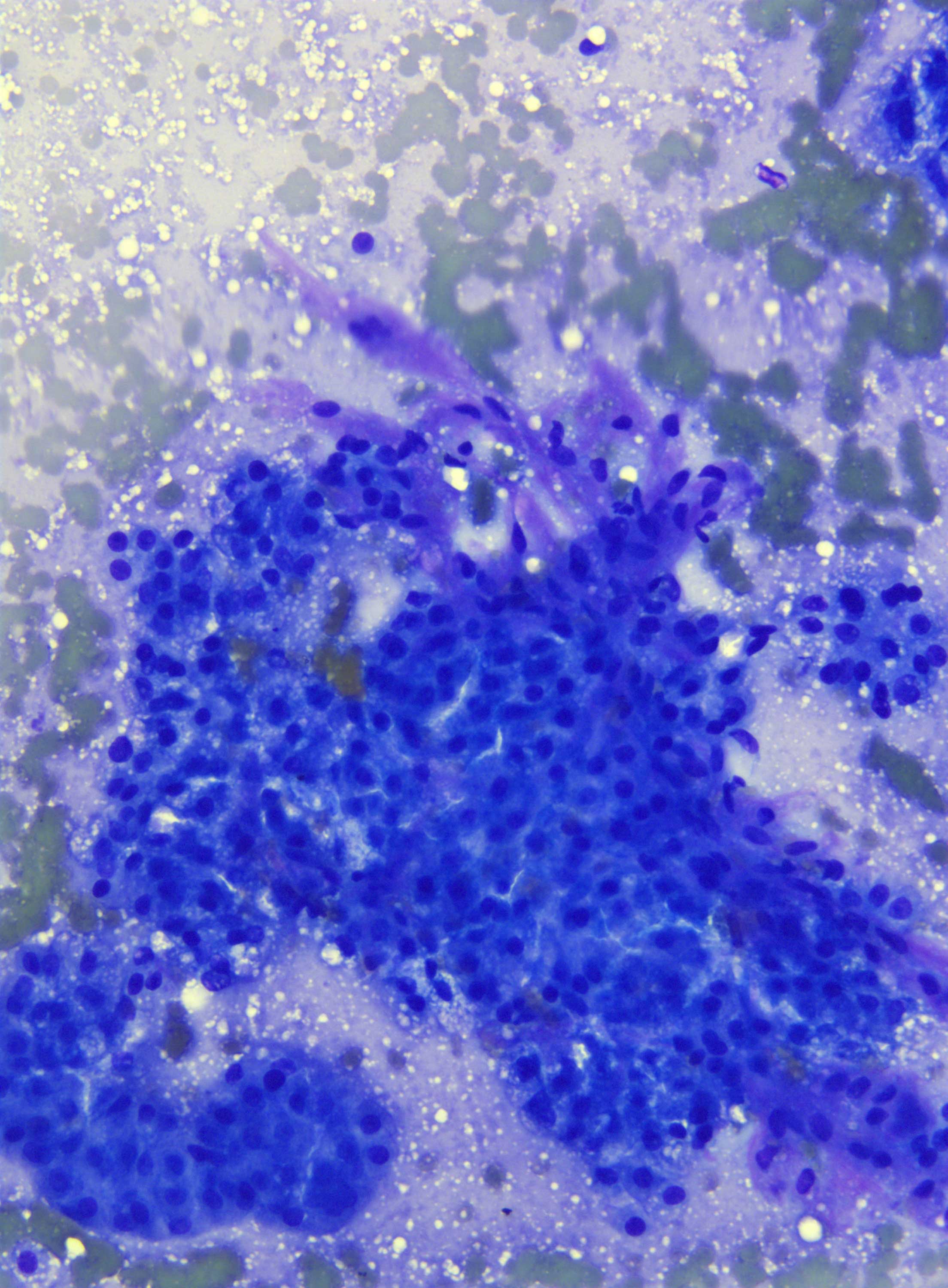 Papanicolaou Society of Cytopathology Case of the Month November 2018