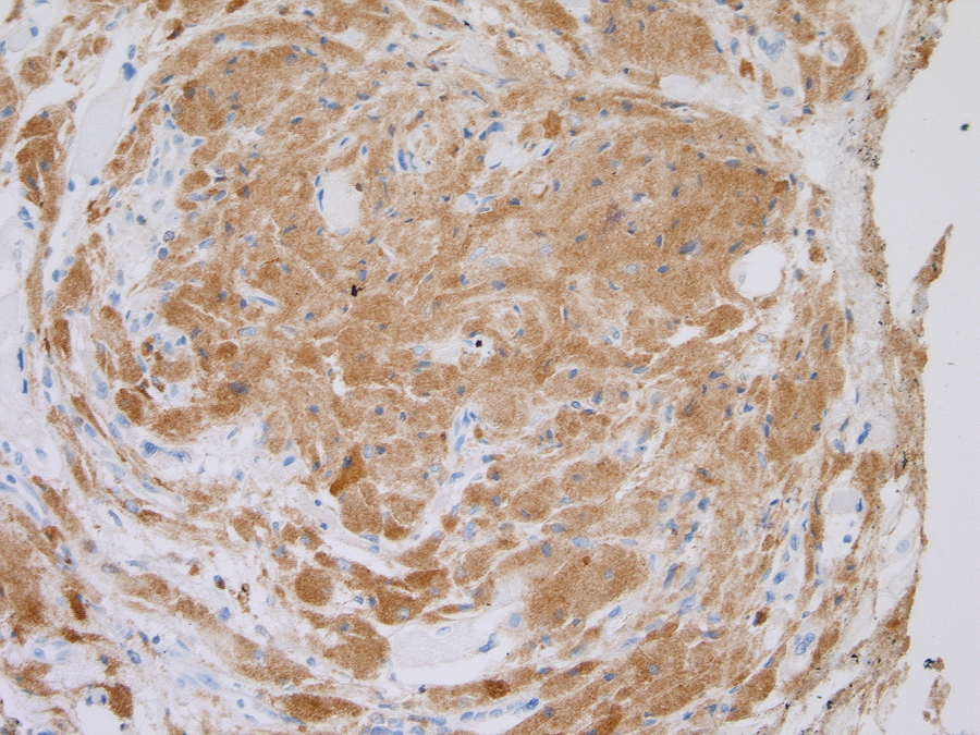 Papanicolaou Society of Cytopathology Case of the Month October 2013