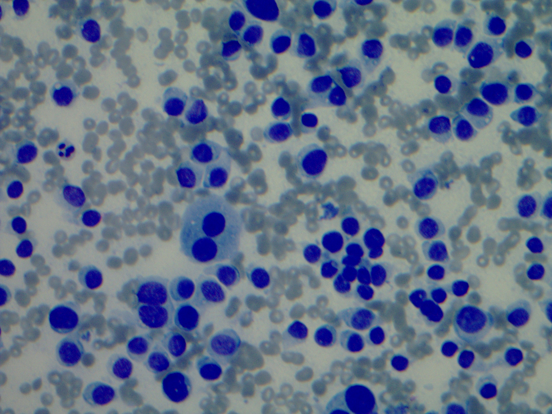 Papanicolaou Society of Cytopathology Case of the Month October 2014